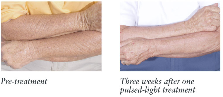 Laser Skincare Treatment