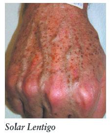 Laser Skincare Treatment